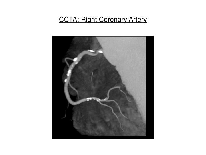 PPT - Coronary Artery Disease PowerPoint Presentation - ID:5832256