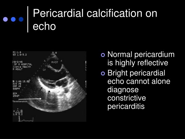PPT - Constrictive Pericarditis PowerPoint Presentation - ID:5836007