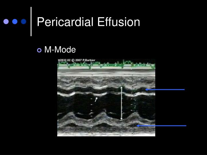 PPT - Constrictive Pericarditis PowerPoint Presentation - ID:5836007