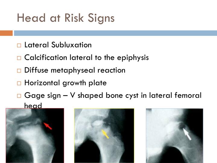 PPT - LegG -Calve- Perthes Disease PowerPoint Presentation - ID:5839224