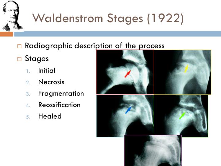 PPT - LegG -Calve- Perthes Disease PowerPoint Presentation - ID:5839224