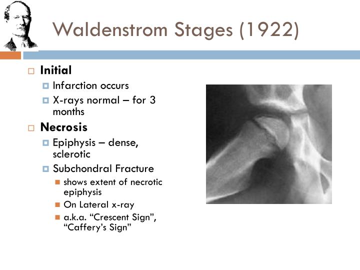 PPT - LegG -Calve- Perthes Disease PowerPoint Presentation - ID:5839224