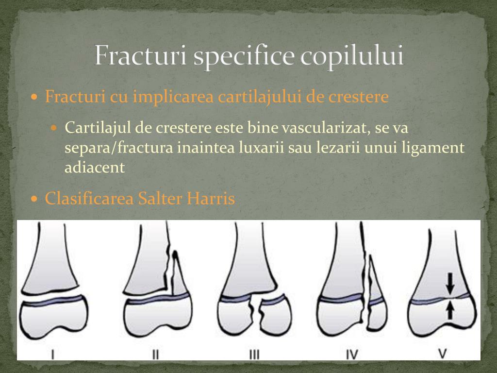 PPT - T ratamentul in urgenta al fracturilor la copil PowerPoint ...