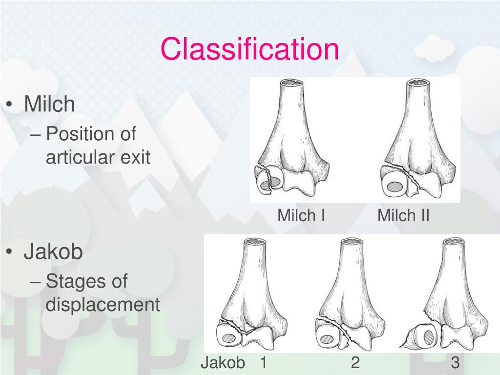 PPT - Lateral Condyle Fractures Sasha Carsen Nov 29 th , 2012 ...
