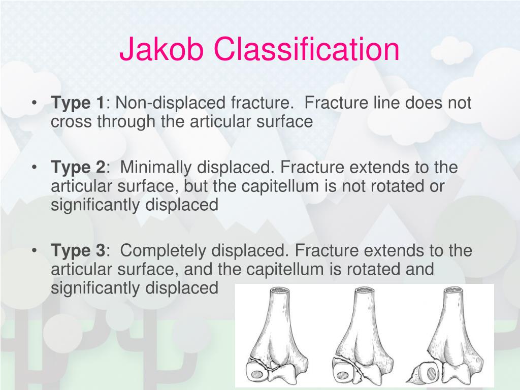 PPT - Lateral Condyle Fractures Sasha Carsen Nov 29 th , 2012 ...