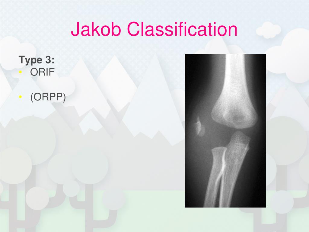 PPT - Lateral Condyle Fractures Sasha Carsen Nov 29 th , 2012 ...