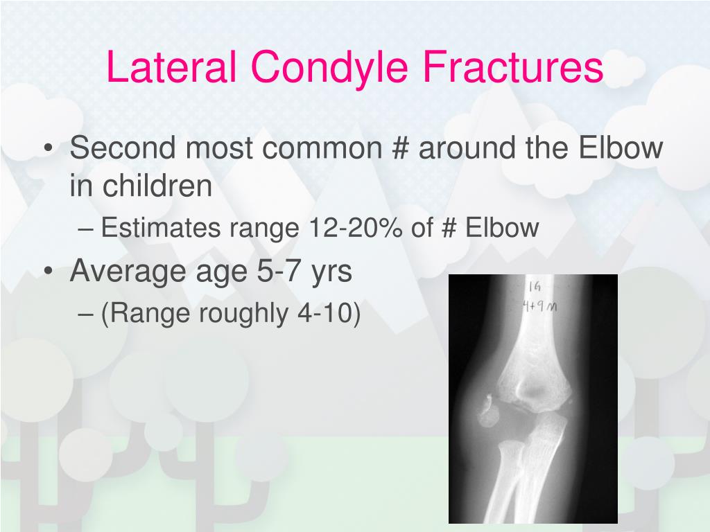 PPT - Lateral Condyle Fractures Sasha Carsen Nov 29 th , 2012 ...