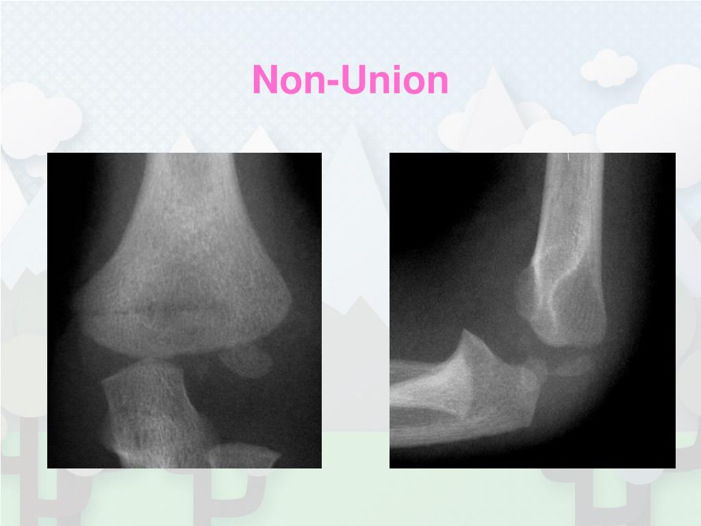 PPT - Lateral Condyle Fractures Sasha Carsen Nov 29 th , 2012 ...