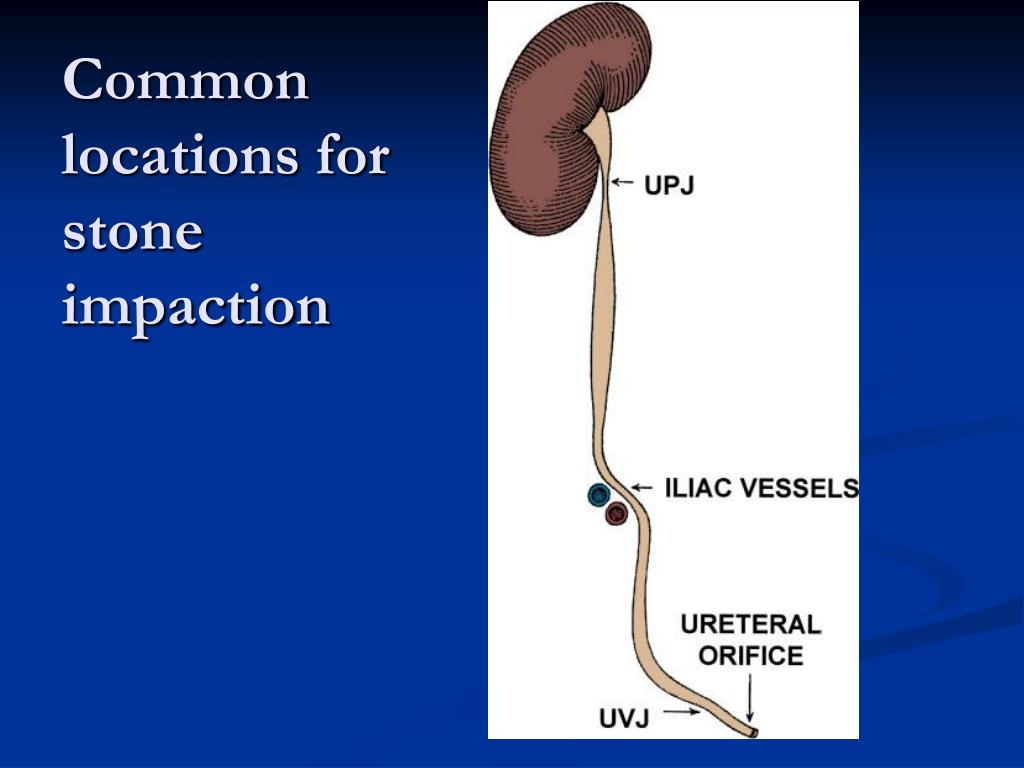 PPT - Medical Expulsion Therapy for Ureteral Calculi PowerPoint ...