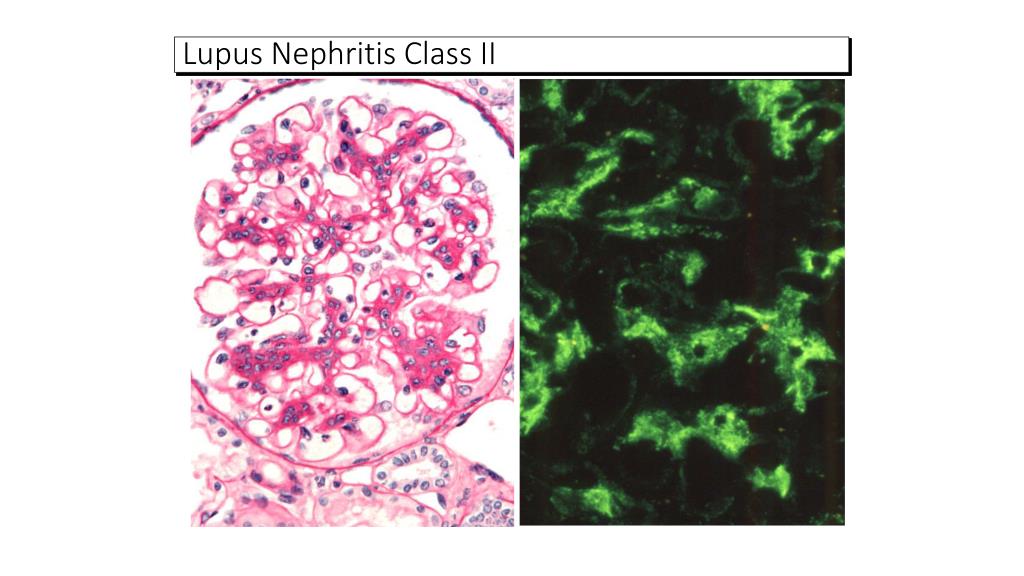 PPT - SLE and Kidney Disease in 2014 GERALD APPEL, MD PowerPoint ...
