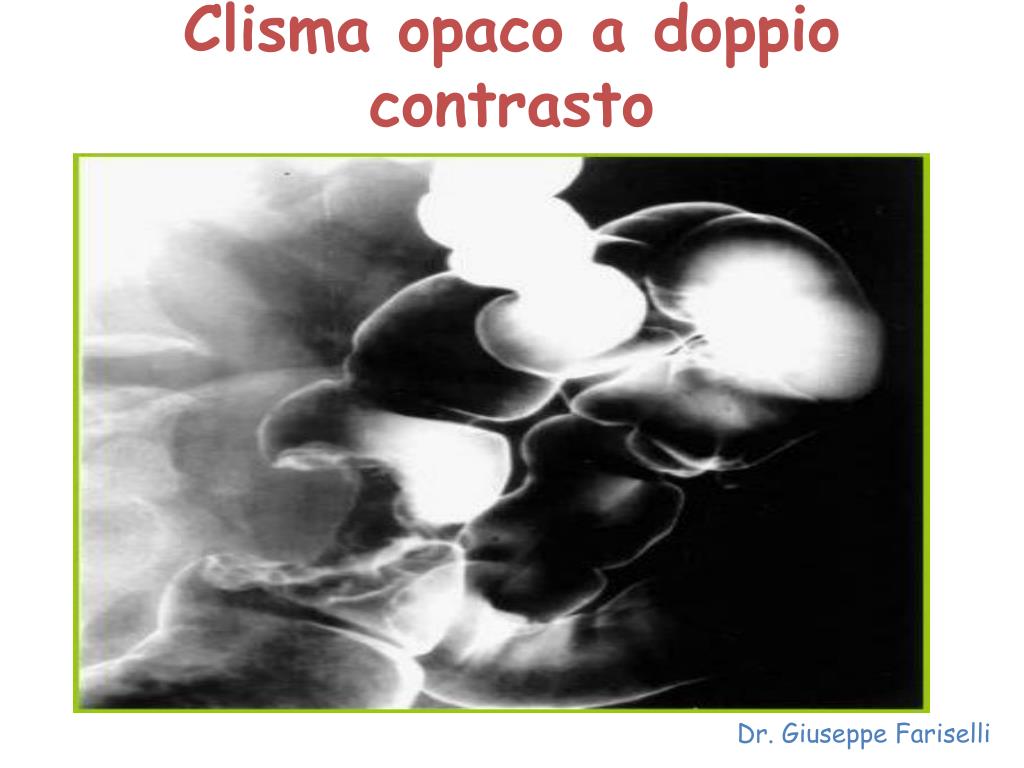 PPT - Il carcinoma intestinale PowerPoint Presentation, free download ...