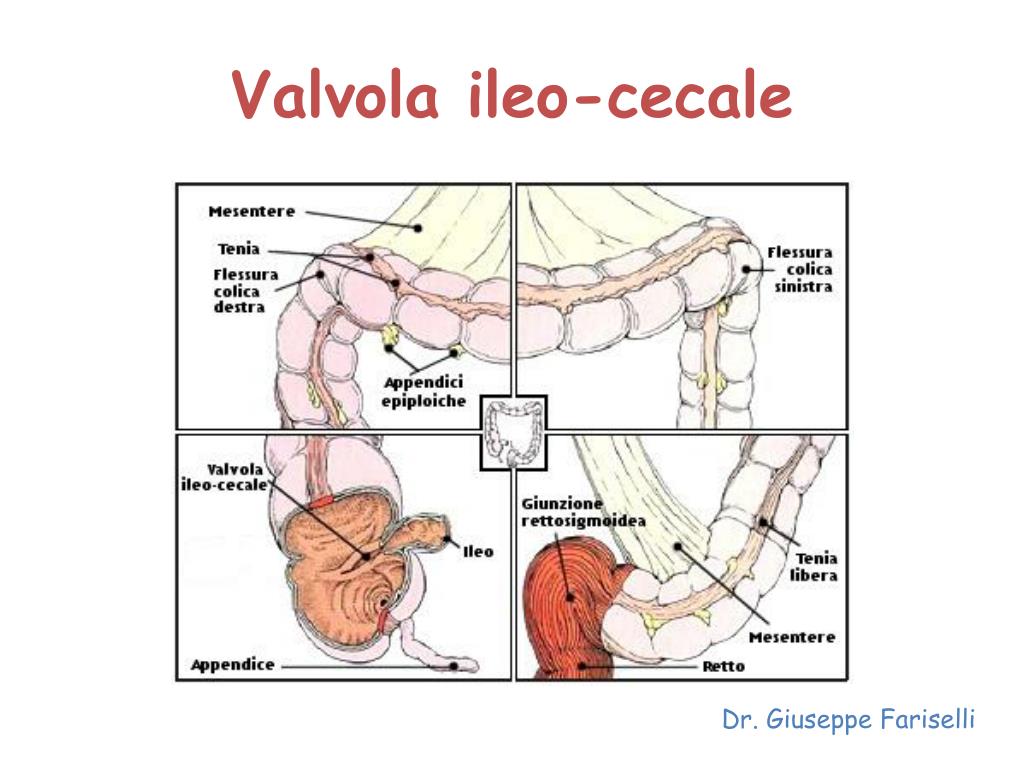 PPT - Il carcinoma intestinale PowerPoint Presentation, free download ...