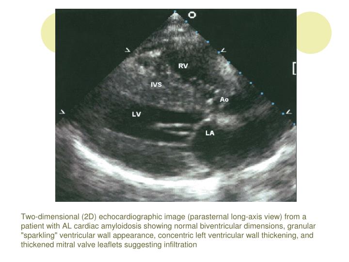 PPT - Cardiac Amyloidosis PowerPoint Presentation - ID:5877977