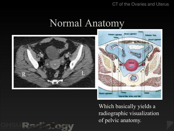 PPT - Body CT Modules: CT of the Ovaries and Uterus PowerPoint ...