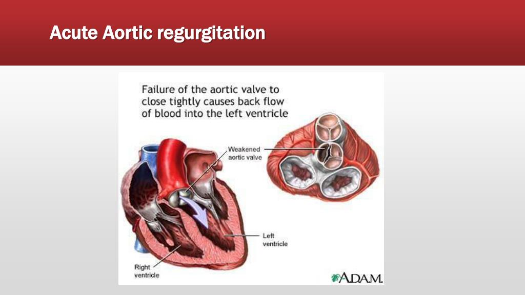 PPT - CARDIOVASCULAR SYSTEM Rheumatic heart disease and valvular ...