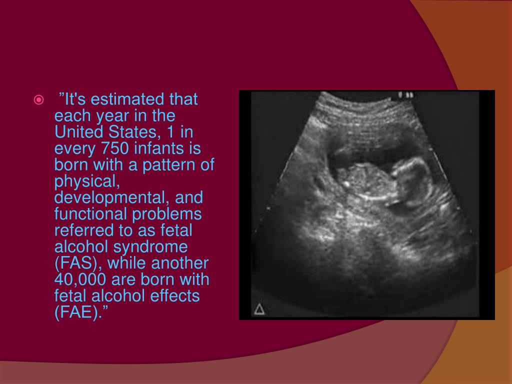 PPT - Fetal Alcohol syndrome PowerPoint Presentation, free download ...