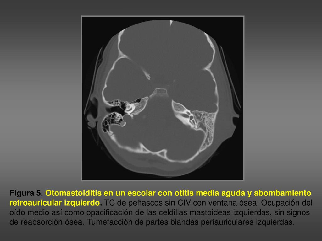 PPT - Urgencias no traumáticas de cabeza y cuello en pediatría ...