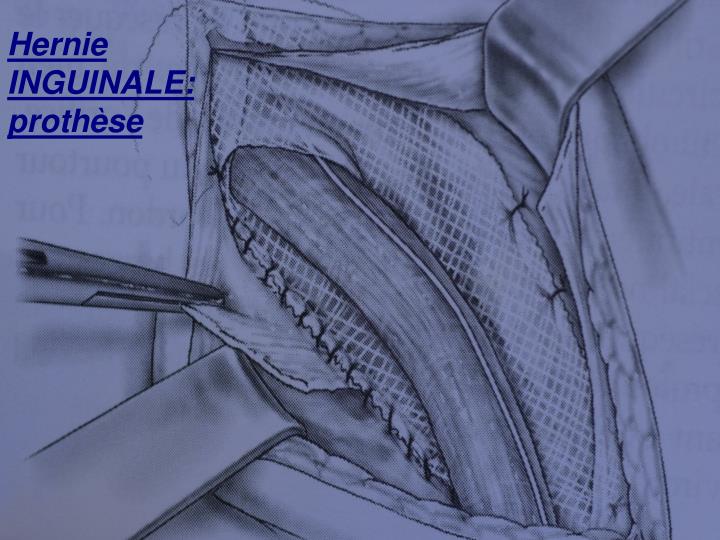 PPT - HERNIES DE L’AINE PowerPoint Presentation - ID:5917180