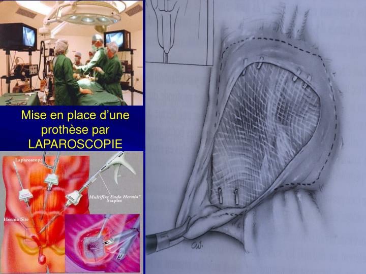 PPT - HERNIES DE L’AINE PowerPoint Presentation - ID:5917180