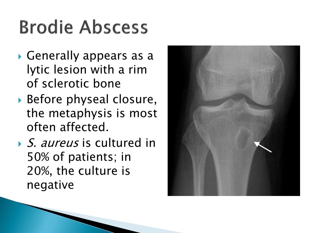 PPT - Paediatric Orthopaedic Infections PowerPoint Presentation, free ...