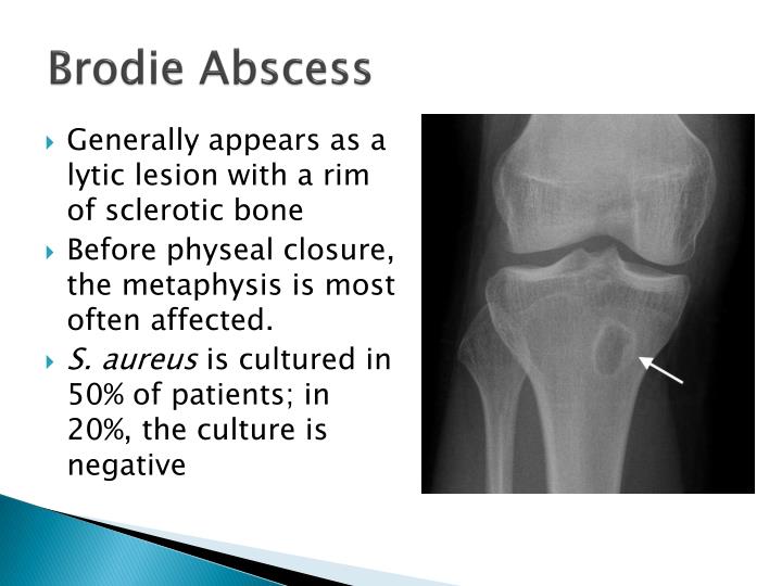 PPT - Paediatric Orthopaedic Infections PowerPoint Presentation - ID ...