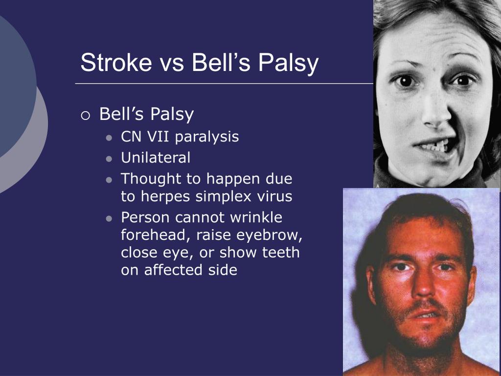 Bell Palsy Anatomy Stroke Vs Bells Palsy How Common I - vrogue.co Bell Palsy Anatomy Stroke Vs Bells Palsy How Common I - vrogue.co