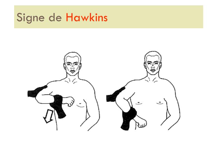 PPT - Pathologie abarticulaire PowerPoint Presentation - ID:5943493