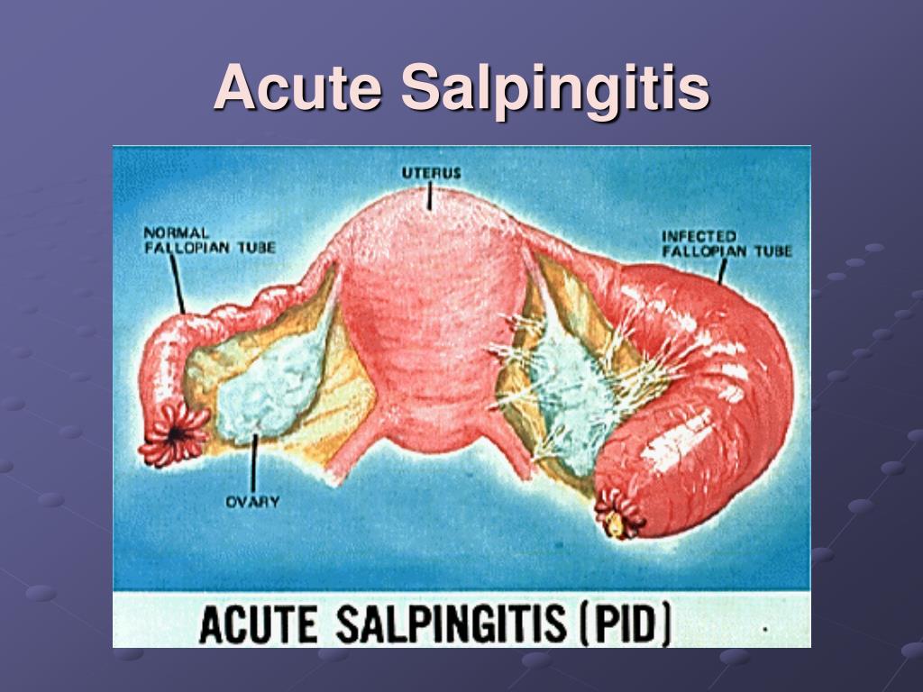PPT - Vulvo-vaginitis & Pelvic Inflammatory Disease (PID) PowerPoint ...