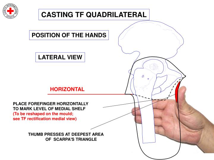 PPT - MEASUREMENTS, CASTING & RECTIFICATION FOR TRANS-FEMORAL (TF ...