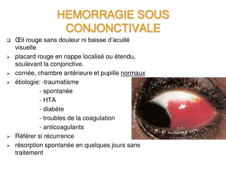 PPT - Le L’OEIL ROUGE PowerPoint Presentation - ID:5992674