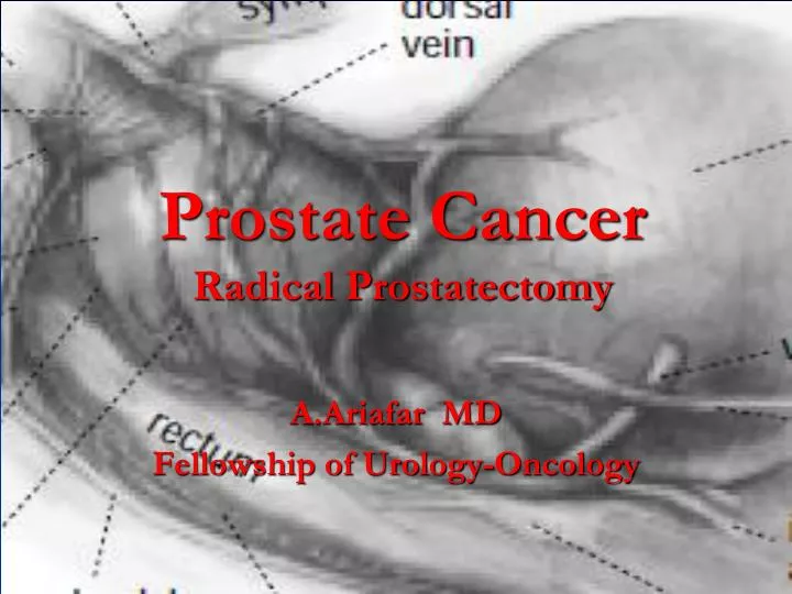 Ppt Prostate Cancer Radical Prostatectomy Powerpoint Presentation Free Download Id6001149