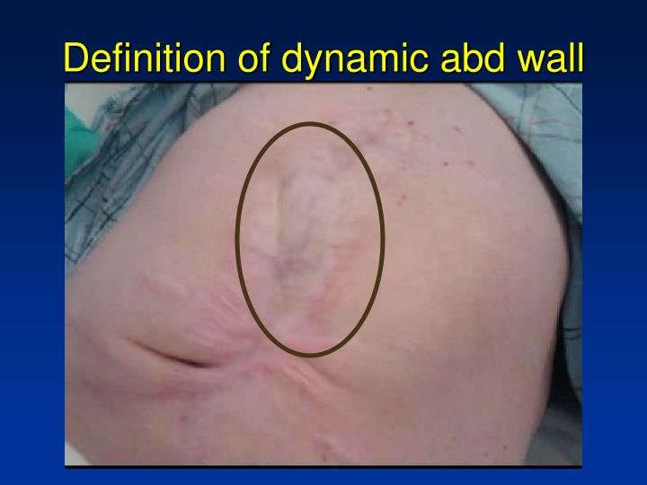 PPT - Restoring Abdominal Wall Function: The Holy Grail? PowerPoint ...