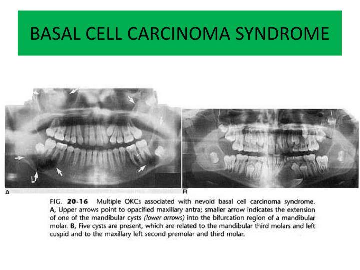 PPT - CYSTS&CYSTLIKE LESIONS OF THE JAWS PowerPoint Presentation - ID ...