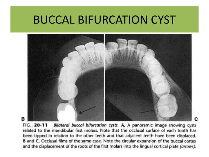 PPT - CYSTS&CYSTLIKE LESIONS OF THE JAWS PowerPoint Presentation - ID ...