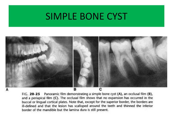 PPT - CYSTS&CYSTLIKE LESIONS OF THE JAWS PowerPoint Presentation - ID ...