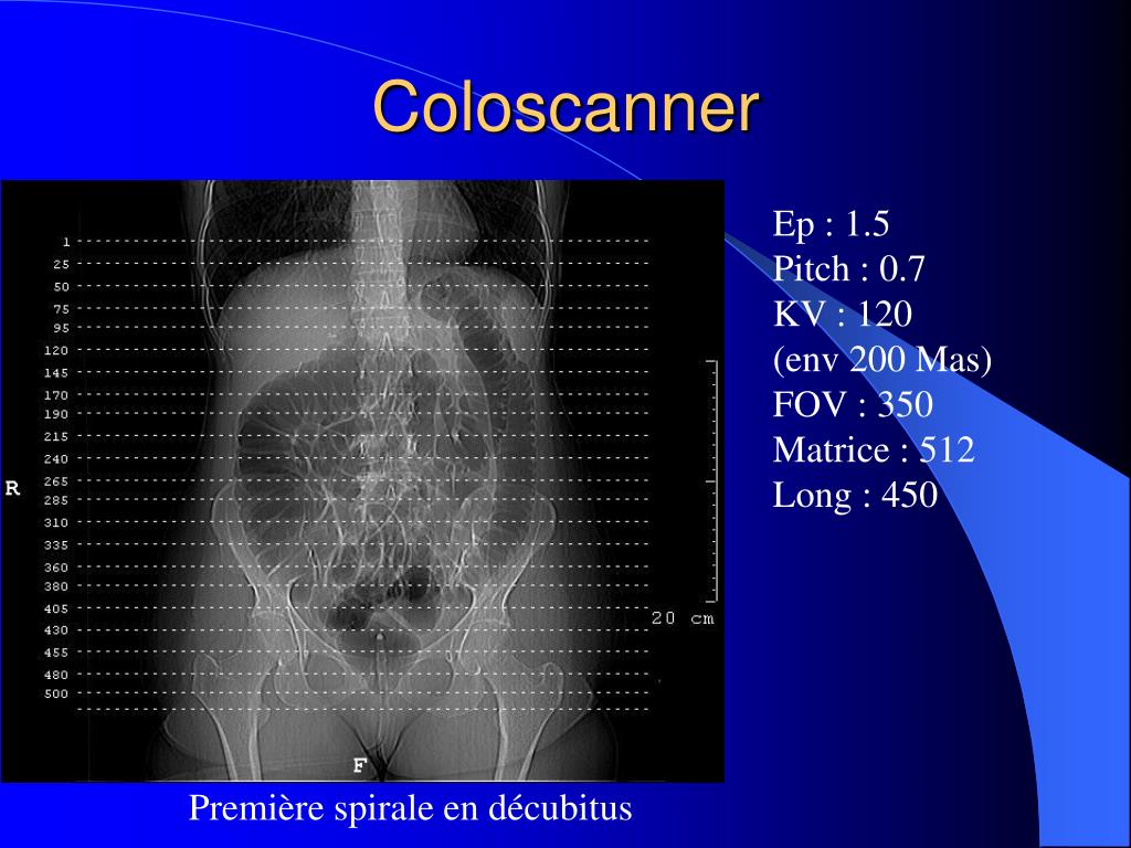 PPT - Angioscanner des coronaires PowerPoint Presentation, free ...