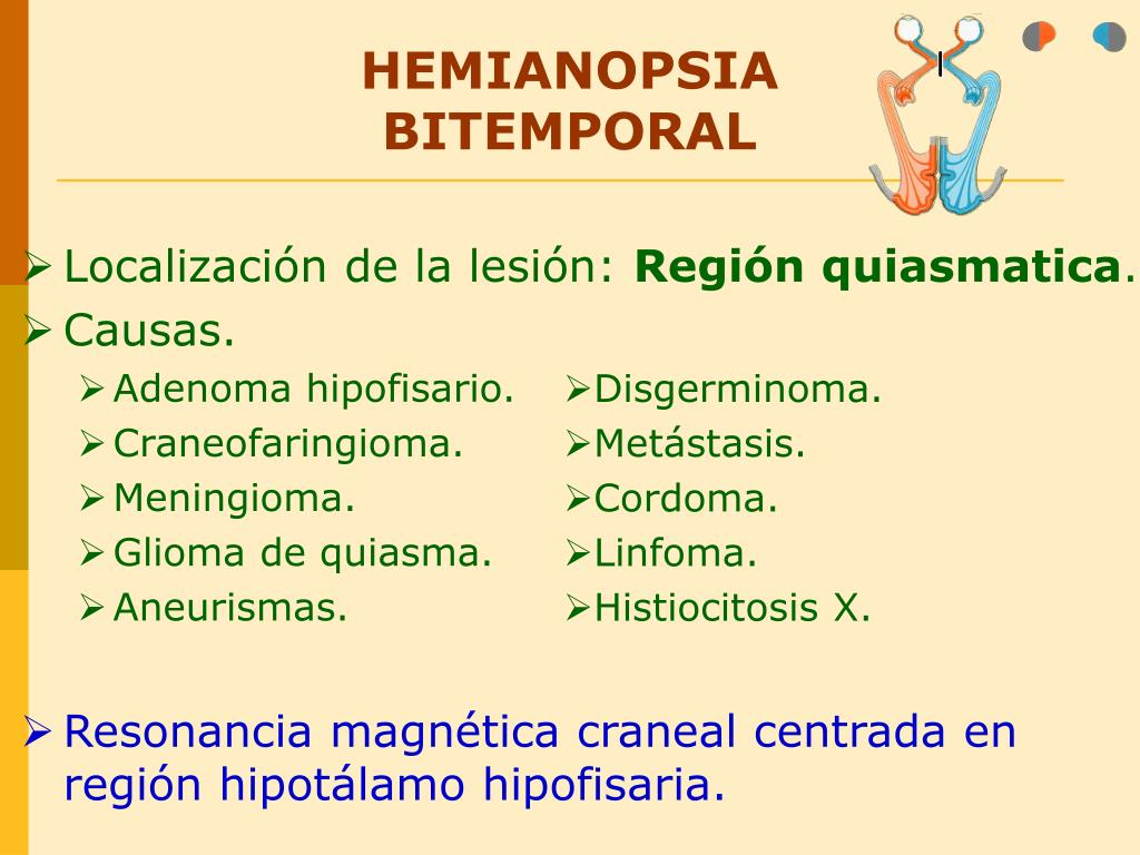 PPT 10 Hemianopsia Bitemporal PowerPoint Presentation Free PPT 10 Hemianopsia Bitemporal PowerPoint Presentation Free
