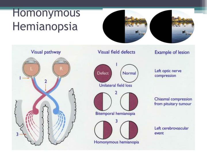 PPT - Cerebrovascular Accident (Stroke) PowerPoint Presentation - ID ...