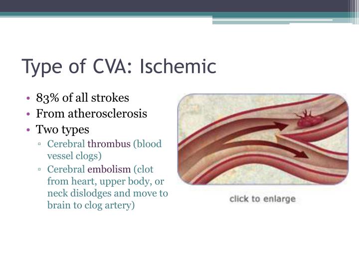 PPT - Cerebrovascular Accident (Stroke) PowerPoint Presentation - ID ...