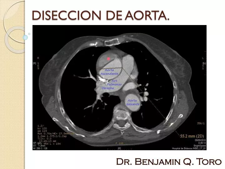PPT - DISECCION DE AORTA. PowerPoint Presentation, free download - ID ...