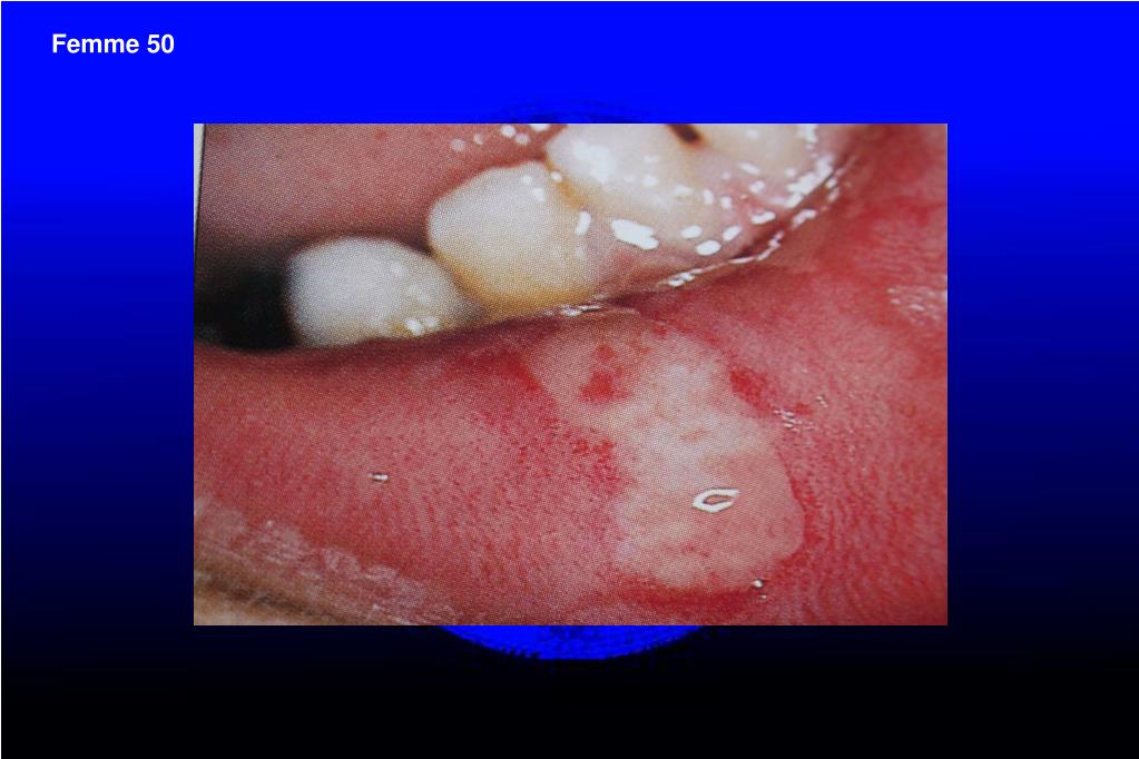 PPT - SEMEIOLOGIE DE LA MUQUEUSE BUCCALE PowerPoint Presentation, free ...