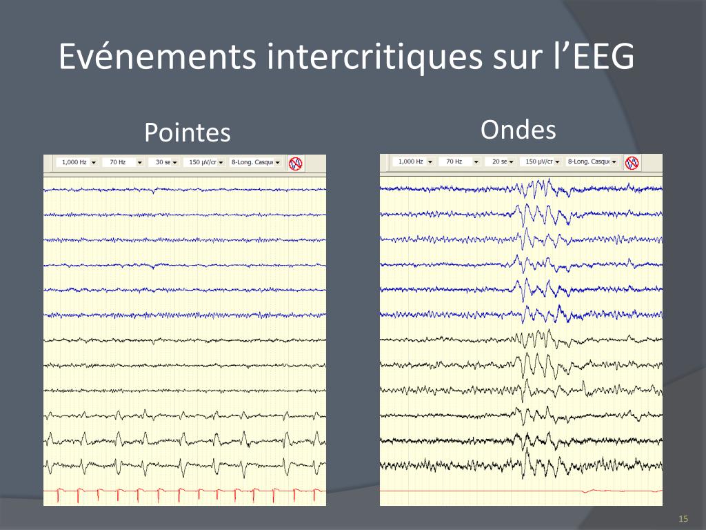 PPT - Cartographie fonctionnelle du cerveau épileptique lors des ...