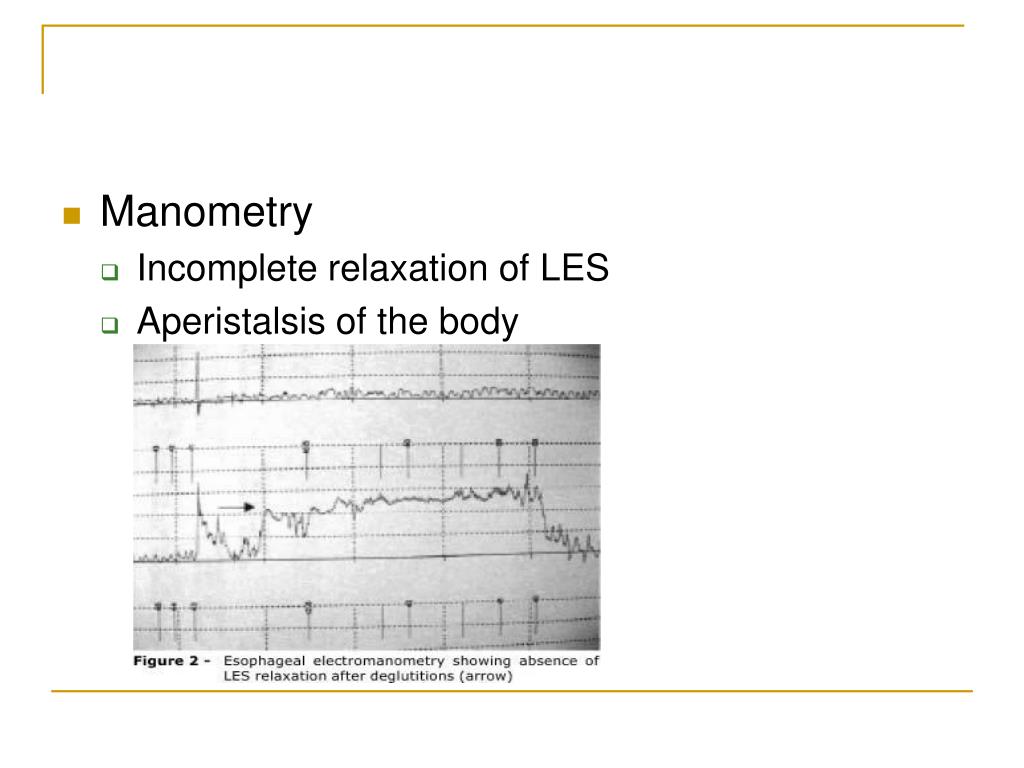 PPT - ESOPHAGEAL MOTILITY DISORDERS PowerPoint Presentation, free ...