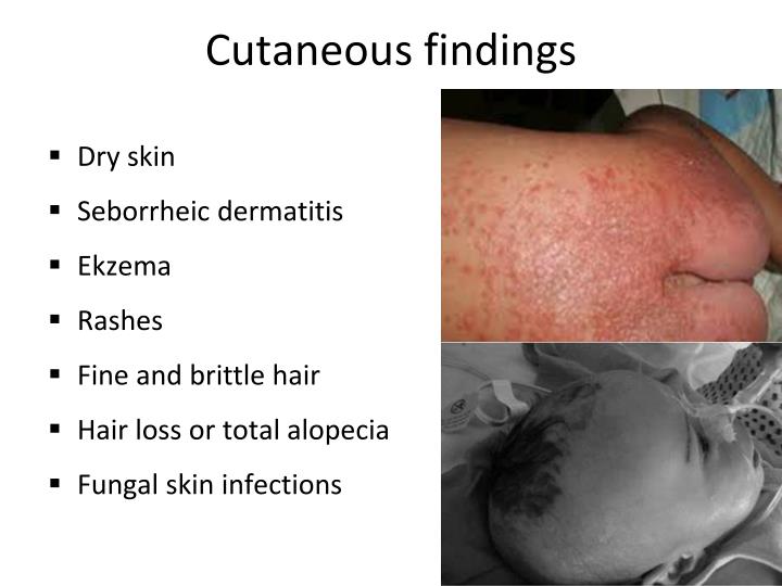 PPT - Biotinidase deficiency: clinical presentation, treatment and ...