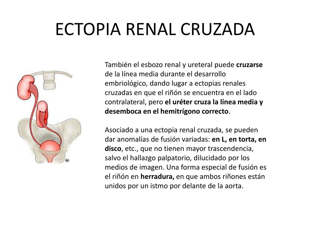 PPT - MALFORMACIONES CONGENITAS DEL APARATO URINARIO PowerPoint ...