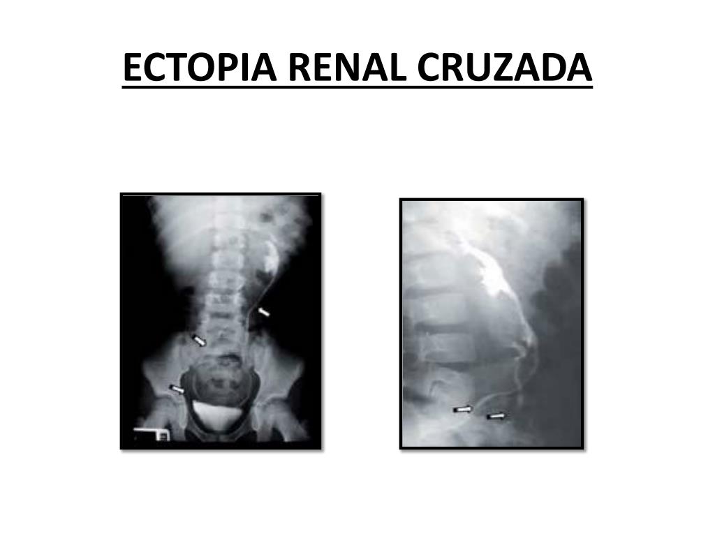PPT - MALFORMACIONES CONGENITAS DEL APARATO URINARIO PowerPoint ...