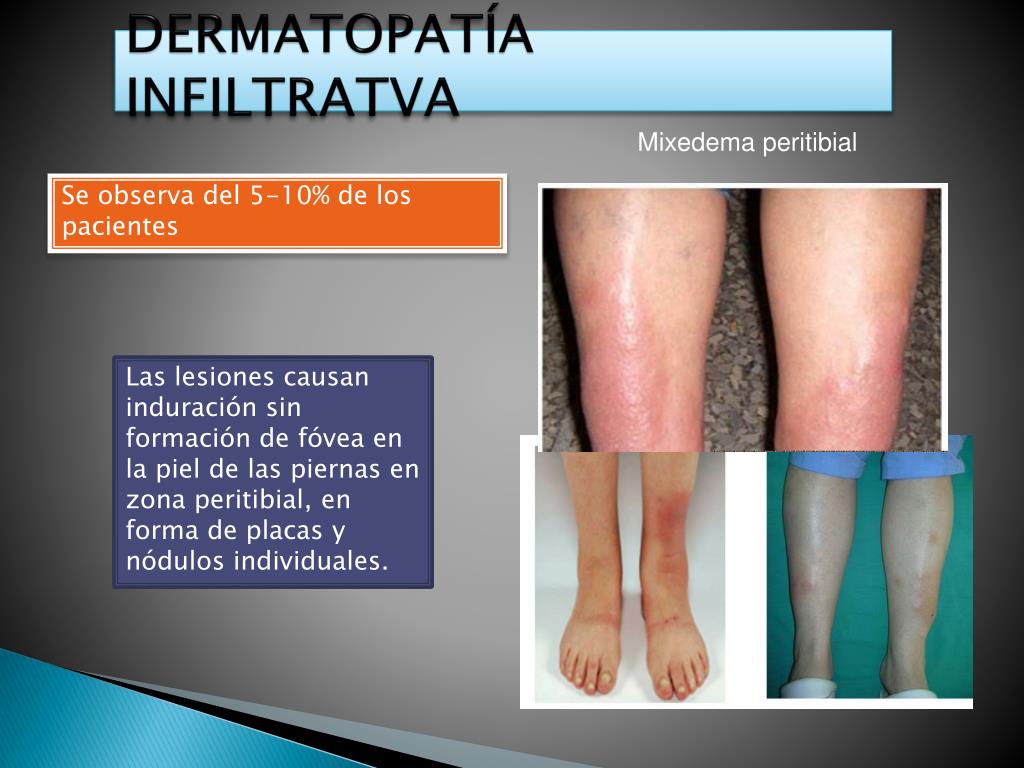 PPT - HIPERTIROIDISMO: ENFERMEDAD DE GRAVES PowerPoint Presentation ...