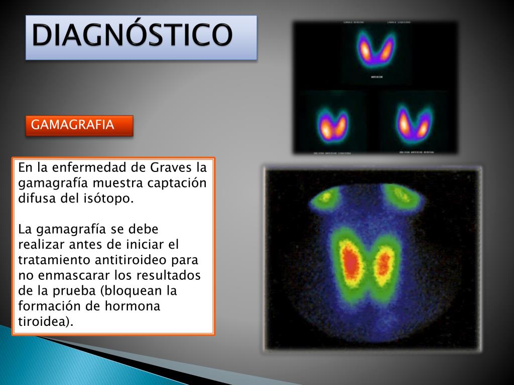 PPT - HIPERTIROIDISMO: ENFERMEDAD DE GRAVES PowerPoint Presentation ...