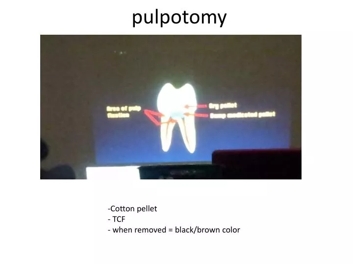 PPT - pulpotomy PowerPoint Presentation, free download - ID:6057226