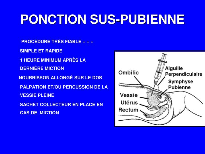 PPT - INFECTION URINAIRE PowerPoint Presentation - ID:6060327